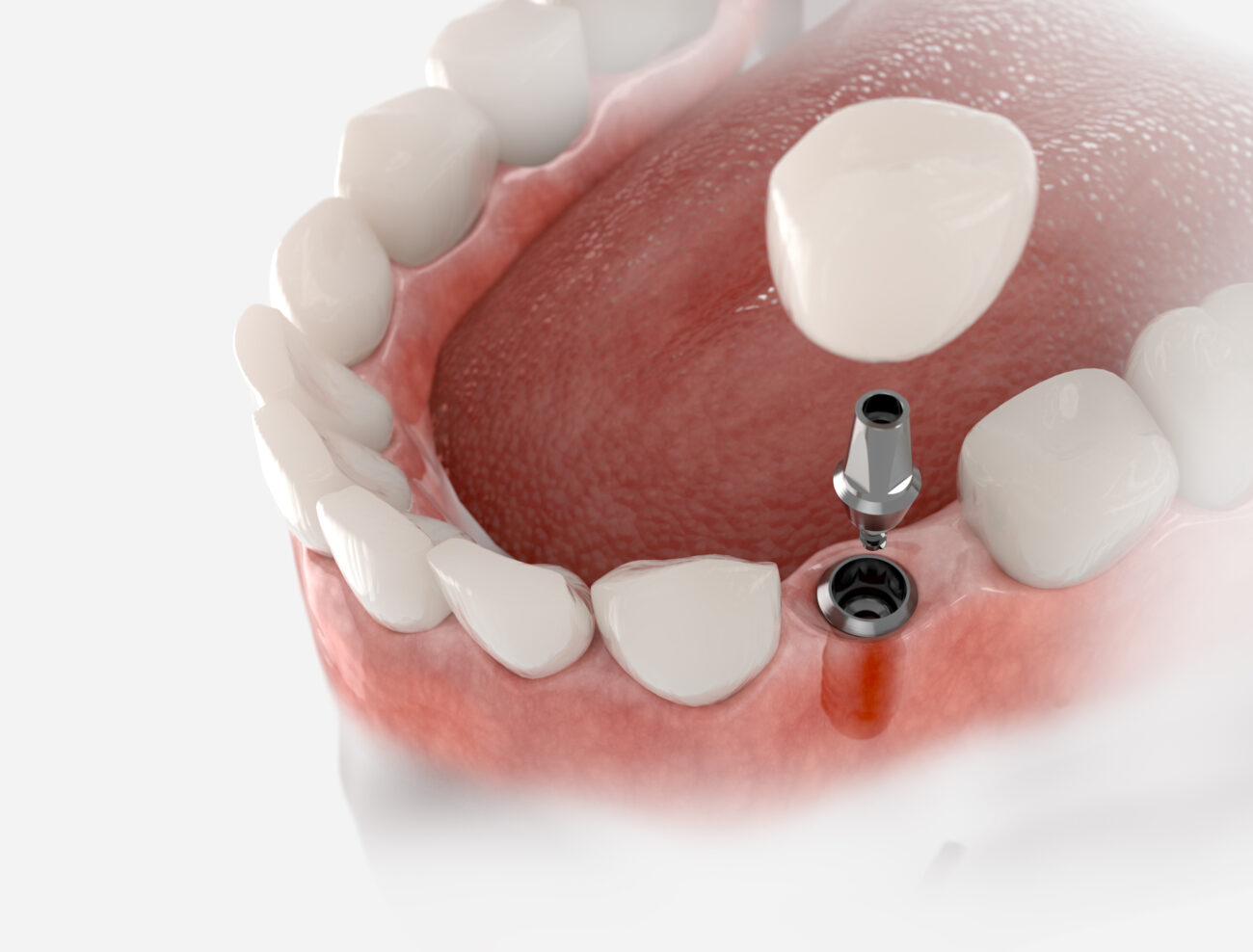 Single Dental Implants in Morristown NJ | Implant Dentistry
